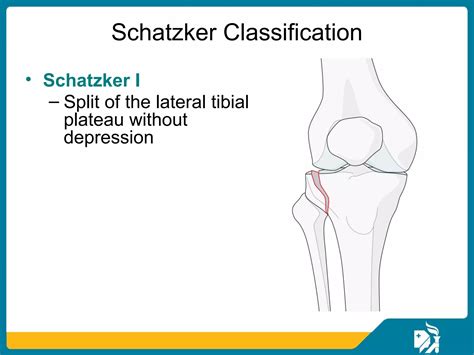 Proximal Tibial Fracture Ppt