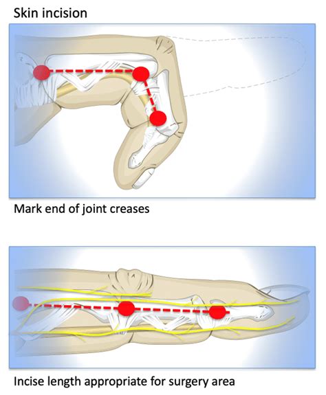 Interphalangeal Finger Joint Dislocation In Bodybuilding Assic Education