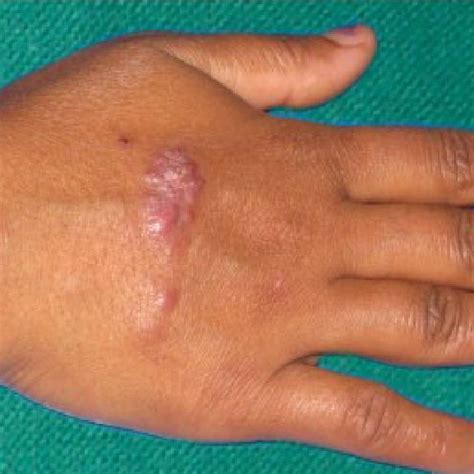 Nodular Lesions Over The Dorsum Of The Hand Case 3 Download
