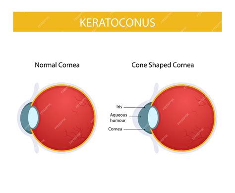 Premium Vector Keratoconus Disease Infographic Design Illustration