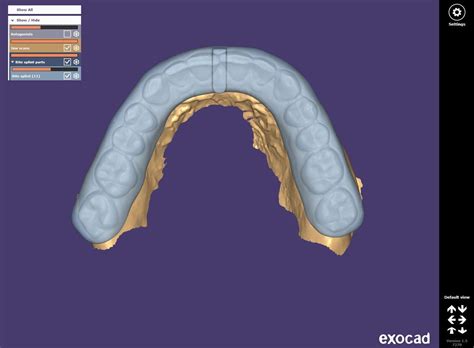 In House 3d Printing Of Occlusal Splint For Patient With Parafunctional