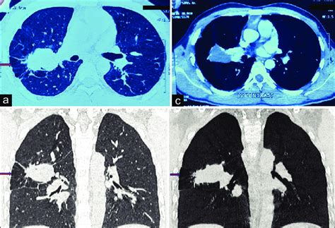 Non Contrast A And B And Contrast Enhanced C Computed Tomography Of