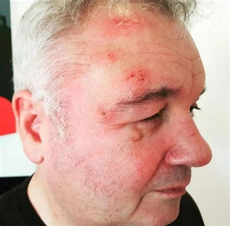 This Mornings Eamonn Holmes Left Looking Bloodied And Blistered After