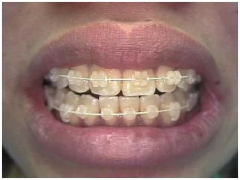 Clear Braces Invisible Braces And Faster Braces