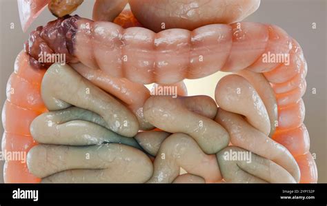 Colorectal Cancer Malignant Tumor In Intestine Endoscope Inside Colonoscopy Gut Intestine
