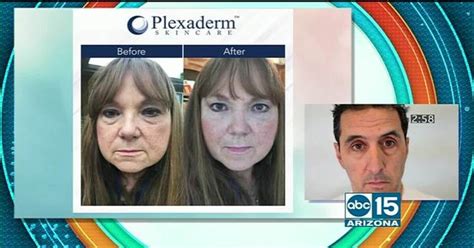 How Does Plexaderm Work