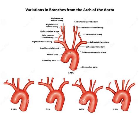 Variations In Branches From The Arch Of The Aorta Stock Illustration