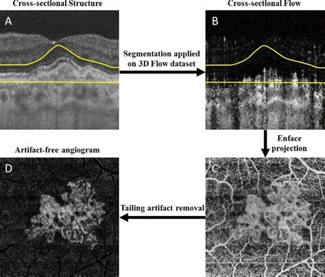 Outer Retina To Choriocapillaris Orcc Optical Coherence Tomography