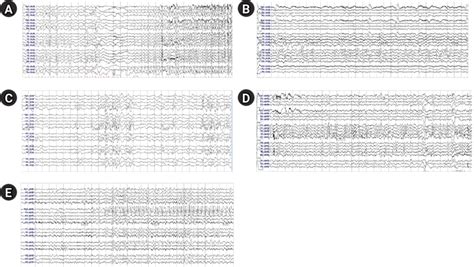 Electroencephalograms Of Patients With Syntaxin Binding Protein 1