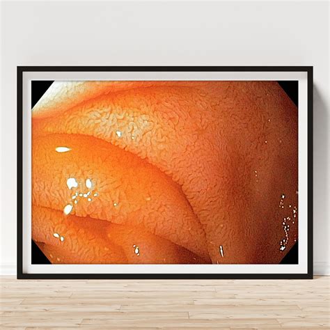Normal Duodenum Poster By Science Photo Library Science Photo Gallery