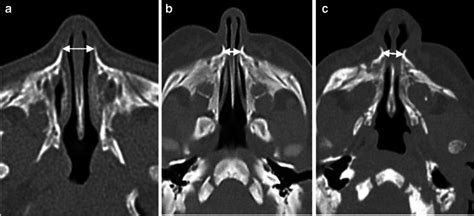 Congenital Nasal Pyriform Aperture Stenosis Radiology