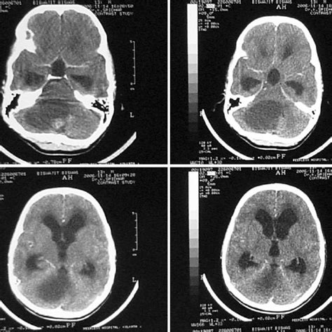 Expansile Pontine Lesion Typical Of A Diffuse Brain Stem Glioma On A Download Scientific