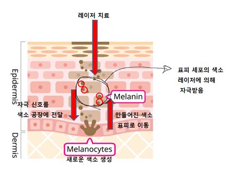 안산 피코토닝 기미치료에 피코토닝 레이저토닝 후 기미가 진해질 수 있을까요 네이버 블로그