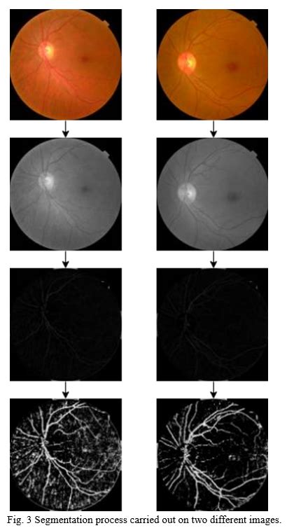 Diabetic Retinopathy Detection Using Convolutional Neural Networks
