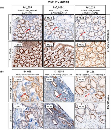 Detection Of Dna Mismatch Repair Deficient Dmmr Crypts Or Glands In Download Scientific