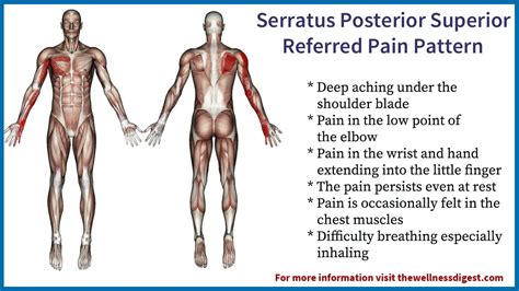 Serratus Posterior Superior Trigger Point Ep 328 The Serratus