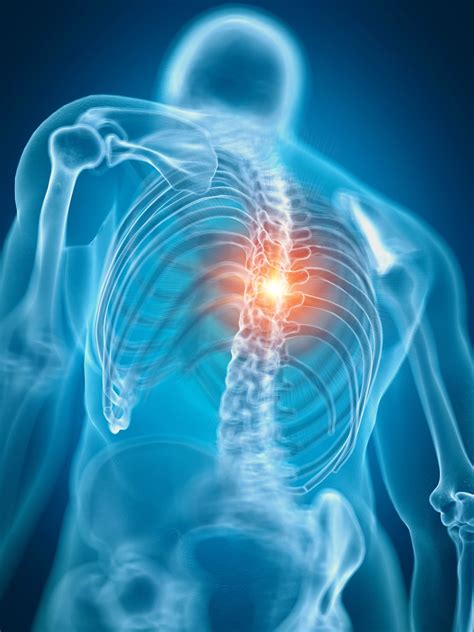 Spinal Cord Compression