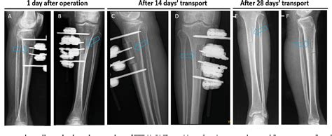 Figure 1 From Tibial Cortex Transverse Transport Facilitating Healing In Patients With