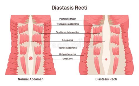 Diastasi Dei Retti Addominali Separazione Dei Muscoli Addominali