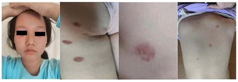 Figure 1 From A Case Of Pustular Pyoderma Gangrenosum Misdiagnosed As Acute Febrile Neutrophilic
