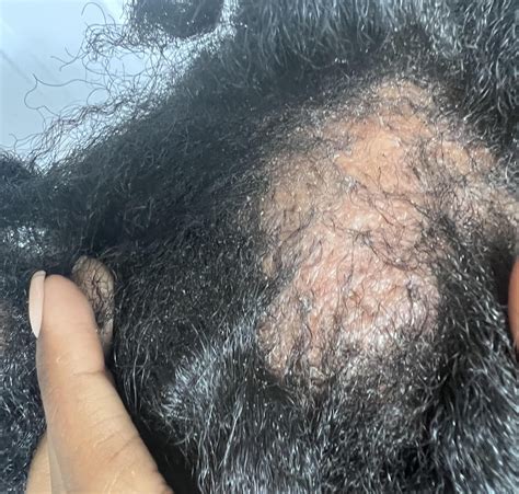 Am I Experiencing Scalp Scarring Rscarringalopecia