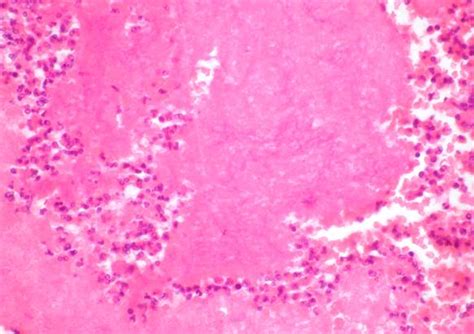 Pulmonary Actinomycosis Mimicking Lung Malignancy Eurorad
