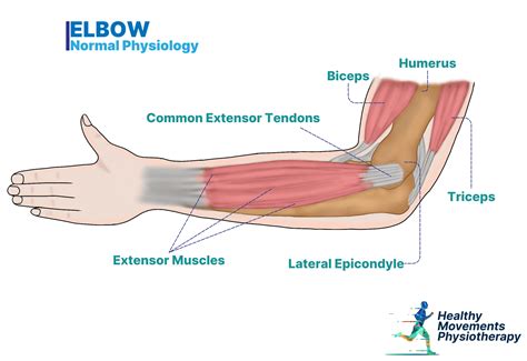 Dry Needling And Tennis Elbow