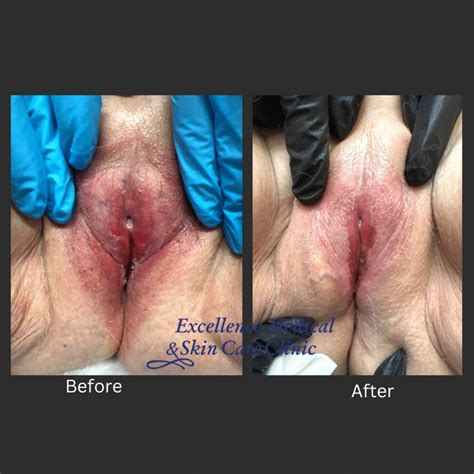 Lichen Sclerosus Gallery Excellence Medical And Skin Care Clinic