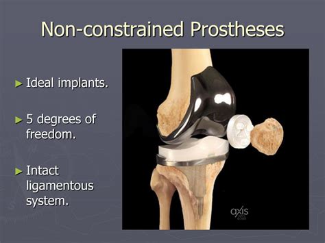 Ppt Total Knee Arthroplasty Powerpoint Presentation Free Download Id 265534