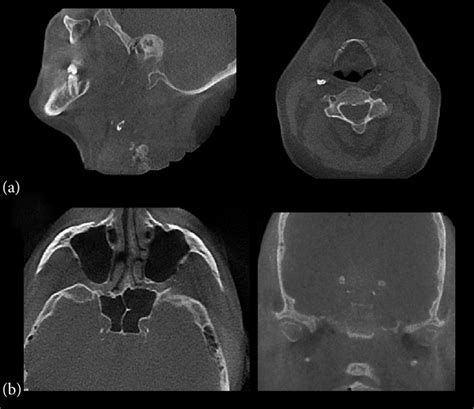 A Sagittal And Axial Cbct Images Showing Extracranial And B Axial
