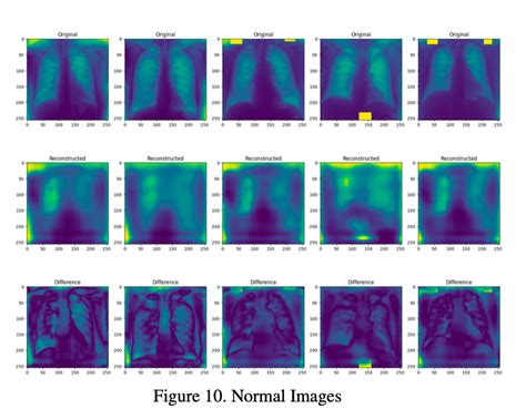 Unsupervised Learning And Anomaly Detection On Medical Images By Vignesh Gopalakrishnan Medium