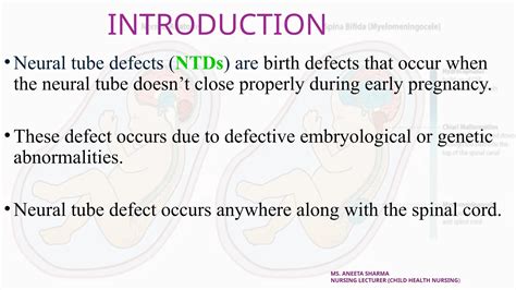 Neural Tube Defect Pptx Pptx