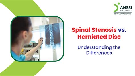 Spinal Stenosis Vs Herniated Disc Understanding The Differences