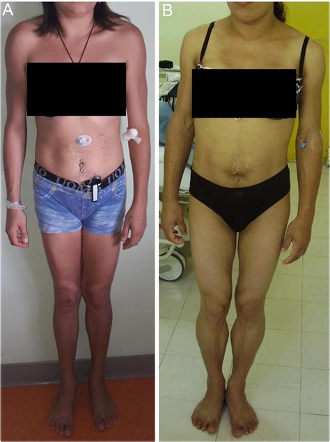 Clinical Features Of Lipodystrophy Were Observed In One Htz A And Hmz Download Scientific