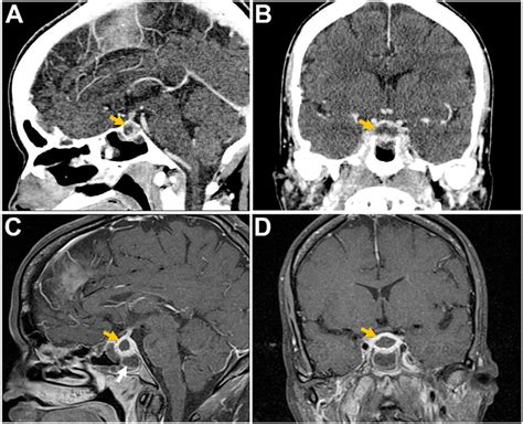 Initial Contrast Enhanced Head Computed Tomography Reformatted Sagittal