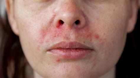 Mild Atopic Dermatitis Face