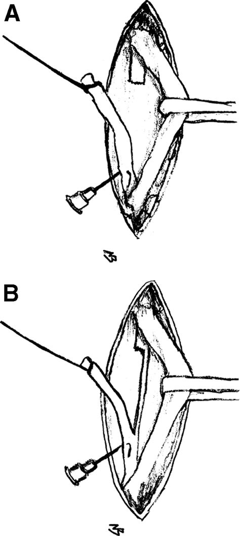 Technique Of The Sural Nerve Biopsy The Journal Of Foot And Ankle Surgery
