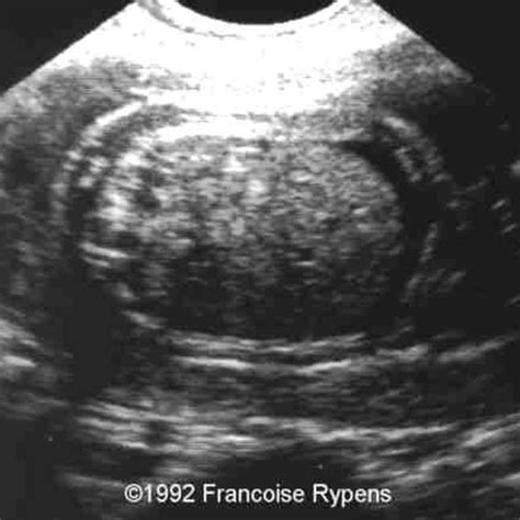 📃 Hemopericardium