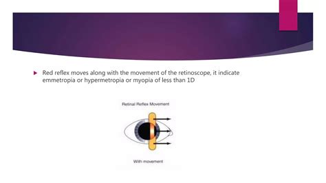 Retinoscopy Pptx