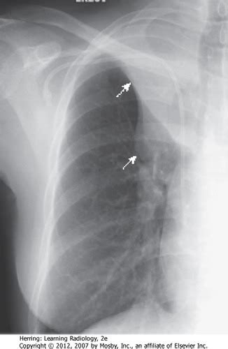 Atelectasis Imaging Flashcards Quizlet