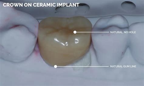 Ceramic Vs Titanium Implants The Crowns Perspective Dr Dan Hagi