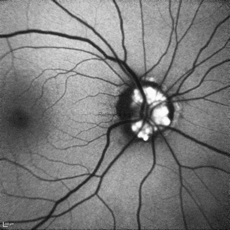 Optic Nerve Head Drusen Retinara