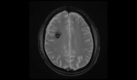 Cavernous Hemangioma Brain