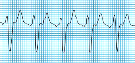 Ecg Of A Patient With Atrial Tachycardia Denoted By Inverted P Waves