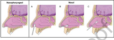 figure 1 from nasopharyngeal versus nasal swabs for detection of sars