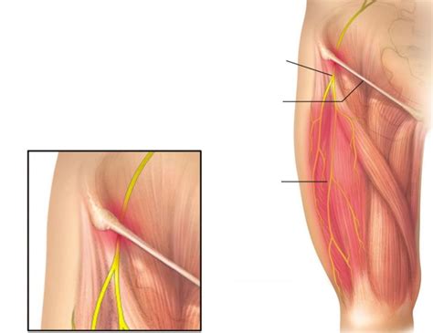Nerve Impingement Diagram Quizlet