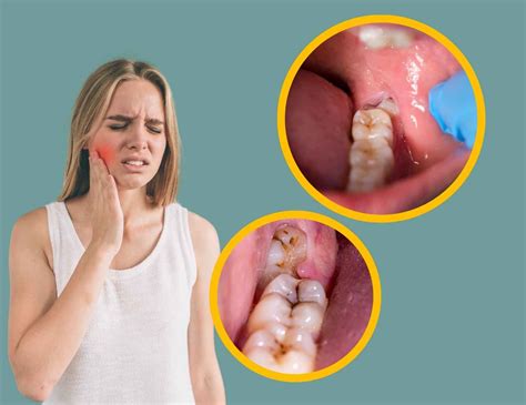 Wisdom Tooth Pain Explained Common Causes Symptoms And Treatment