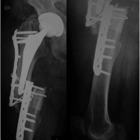 Hardware Failure 4 Days After The Surgery Download Scientific Diagram Hardware Failure 4 Days After The Surgery Download Scientific Diagram