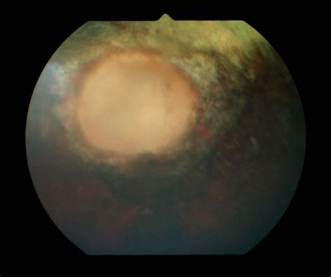 Imageoptic Nerve Atrophy And Peripapillary Retinal Degeneration Horse