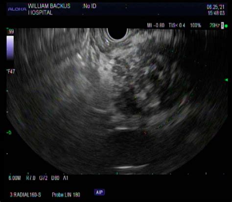 Hypoechoic Gland With Hyperechoic Foci Without Shadowing Download Scientific Diagram